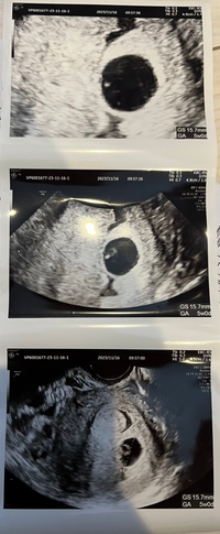 心拍確認できません。7w0dで初めて病院に行ったところ胎嚢のみ見えました。心拍... - Yahoo!知恵袋