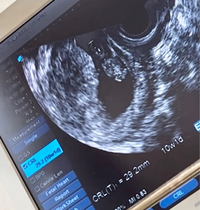 10w1dに検診に行くと、赤ちゃんが8週の形と言われました。ですがCRLは29... - Yahoo!知恵袋