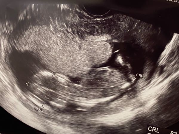 16w6dの時のエコー写真です！ - 先生には男の子疑惑との... - Yahoo!知恵袋