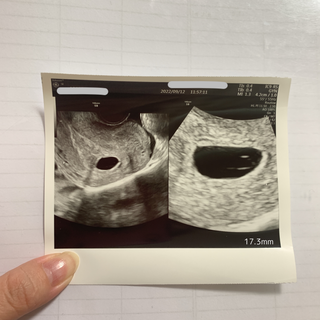 6w5dで胎嚢しか確認できず。これは流産になりますか？不妊治... - Yahoo!知恵袋