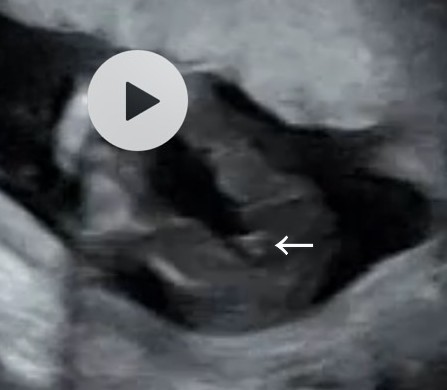 16w6dの時のエコーです。足と足の間に映ってる矢印の丸いのなんだと思い... - Yahoo!知恵袋